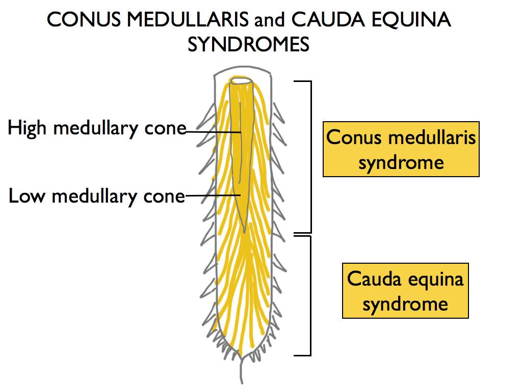 Cauda Equina Syndrome Vs Conus Medullaris Syndrome
