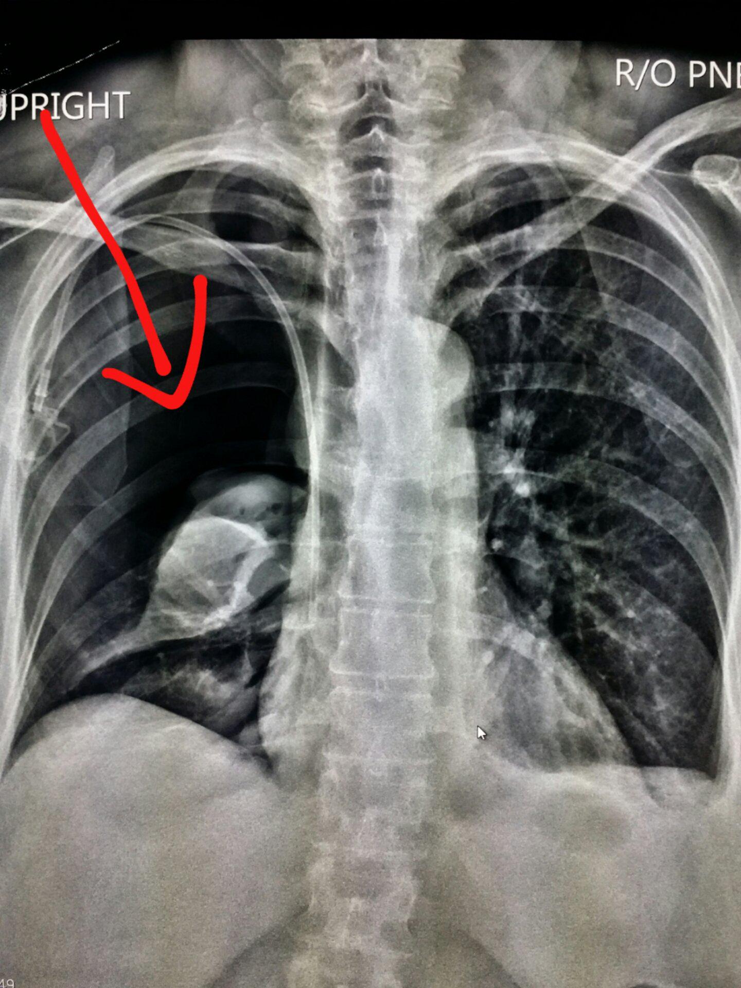 Collapsed Lung X Ray