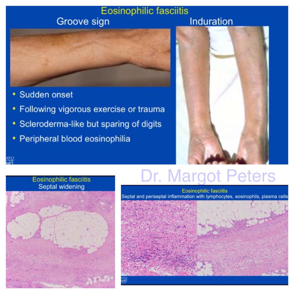Eosinophilic Fasciitis Groove Sign