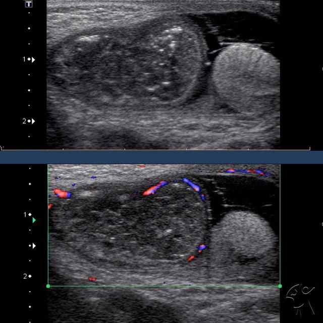 Scrotal Hernia Ultrasound Sonography Of Inguinal Region Hernias | AJR