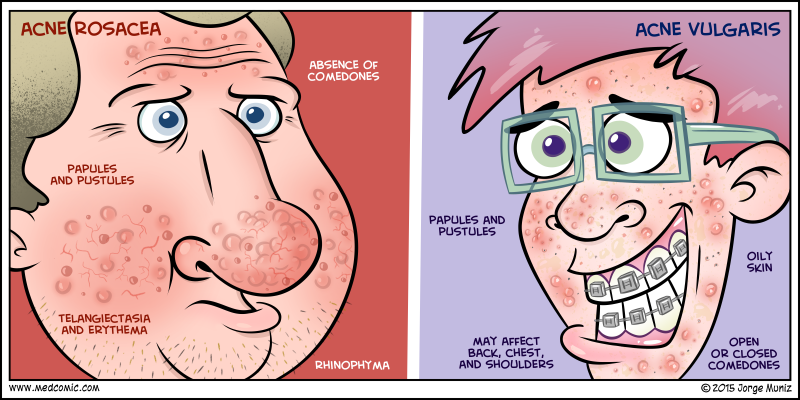 Acne Rosacea Vs Acne Vulgaris