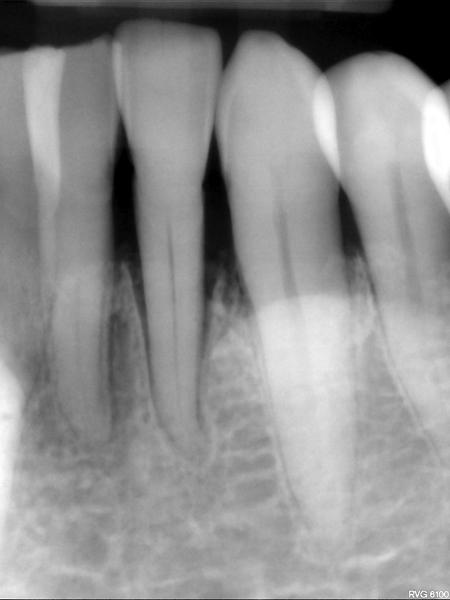 Periodontal Ligament Space
