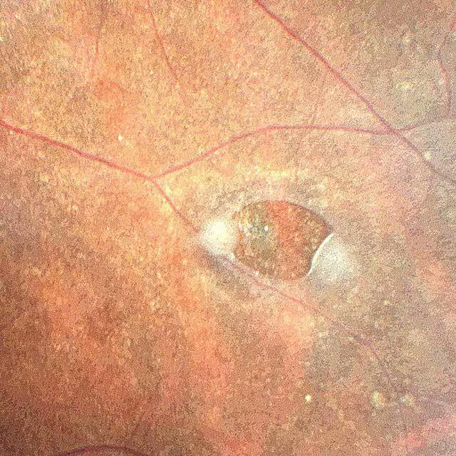 Operculated Retinal Hole