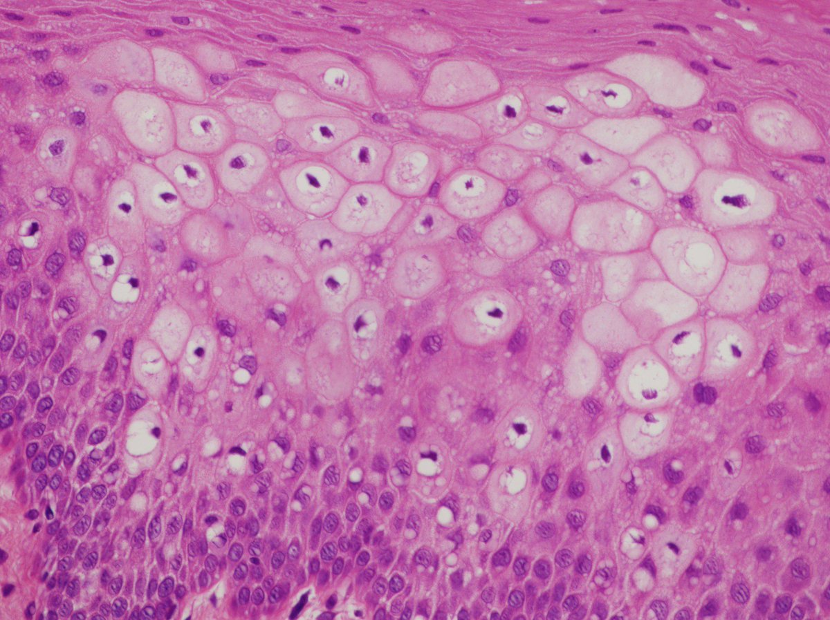 White Sponge Nevus Oral Infection By Staphylococcus Aureus In Patients