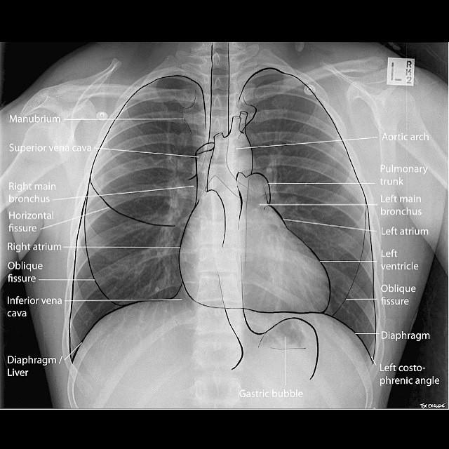 “@dra_samadhi: tele de tórax. #radiologia ” - scoopnest.com