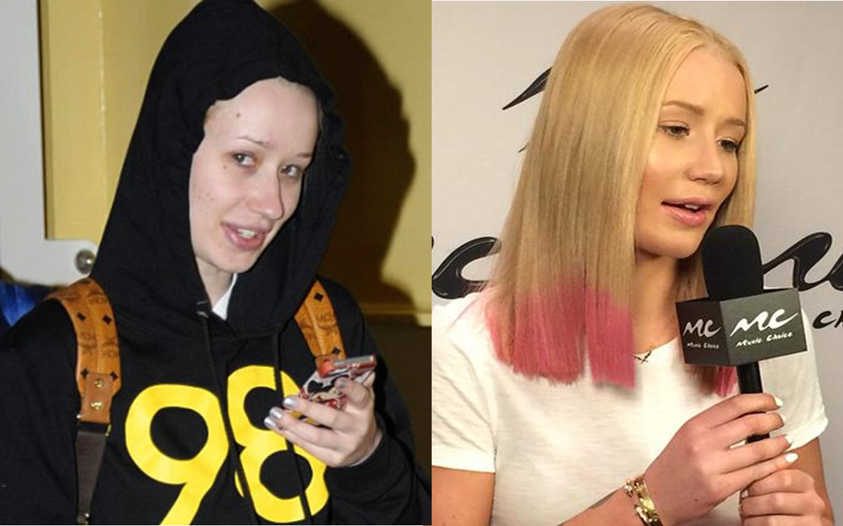 Iggy Azalea Plastic Surgery Before And After