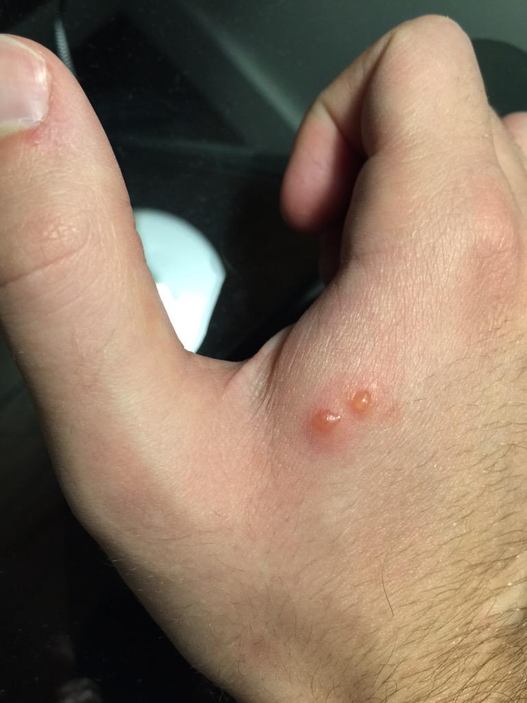 Disgusting Bug Bites