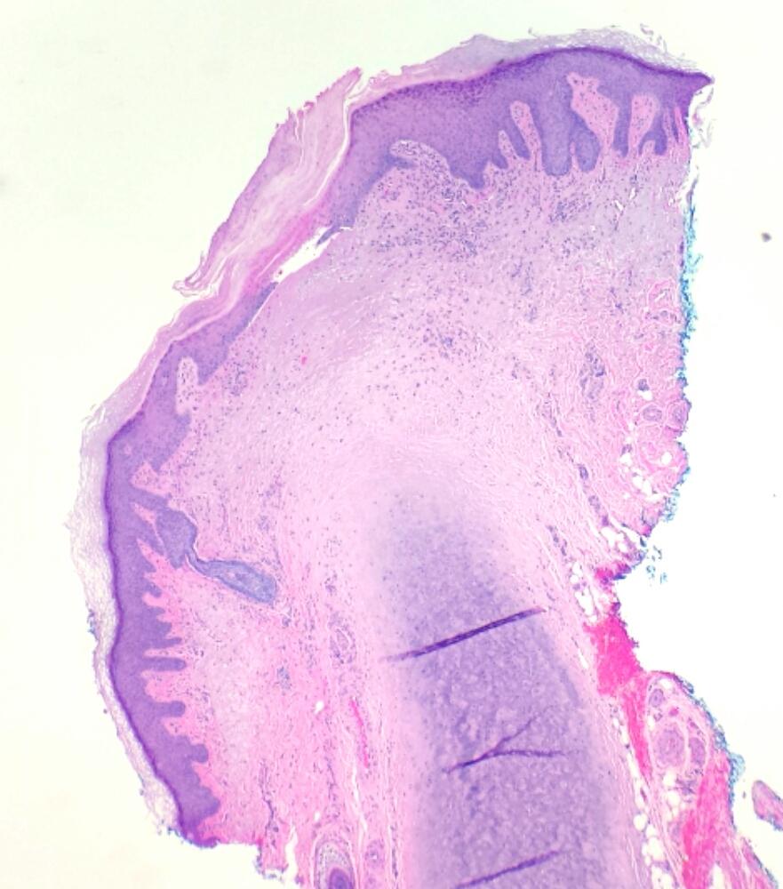Chondrodermatitis Nodularis Helicis Histology