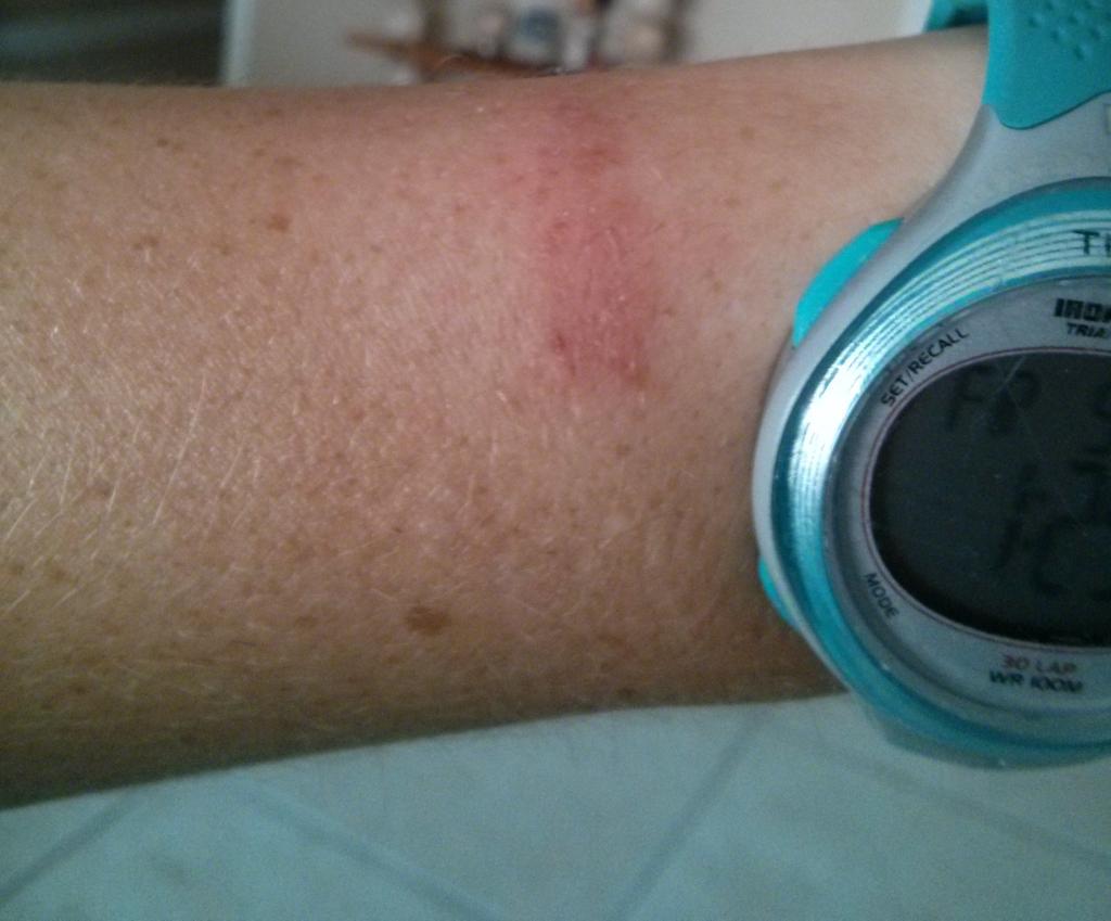 Fire Coral Burn