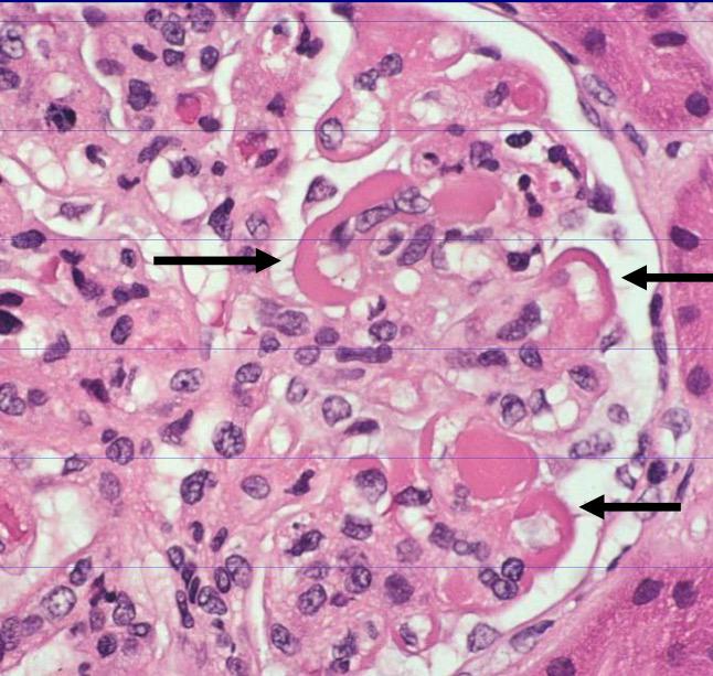 Diffuse Proliferative Glomerulonephritis Wire Looping