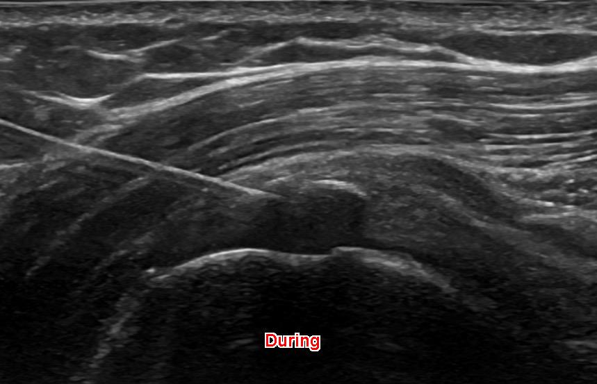 Ultrasound Guided Barbotage Procedure For Calcific