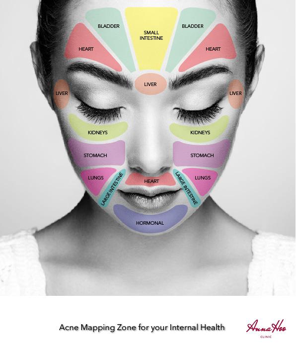 Acne Diagram Of The Face