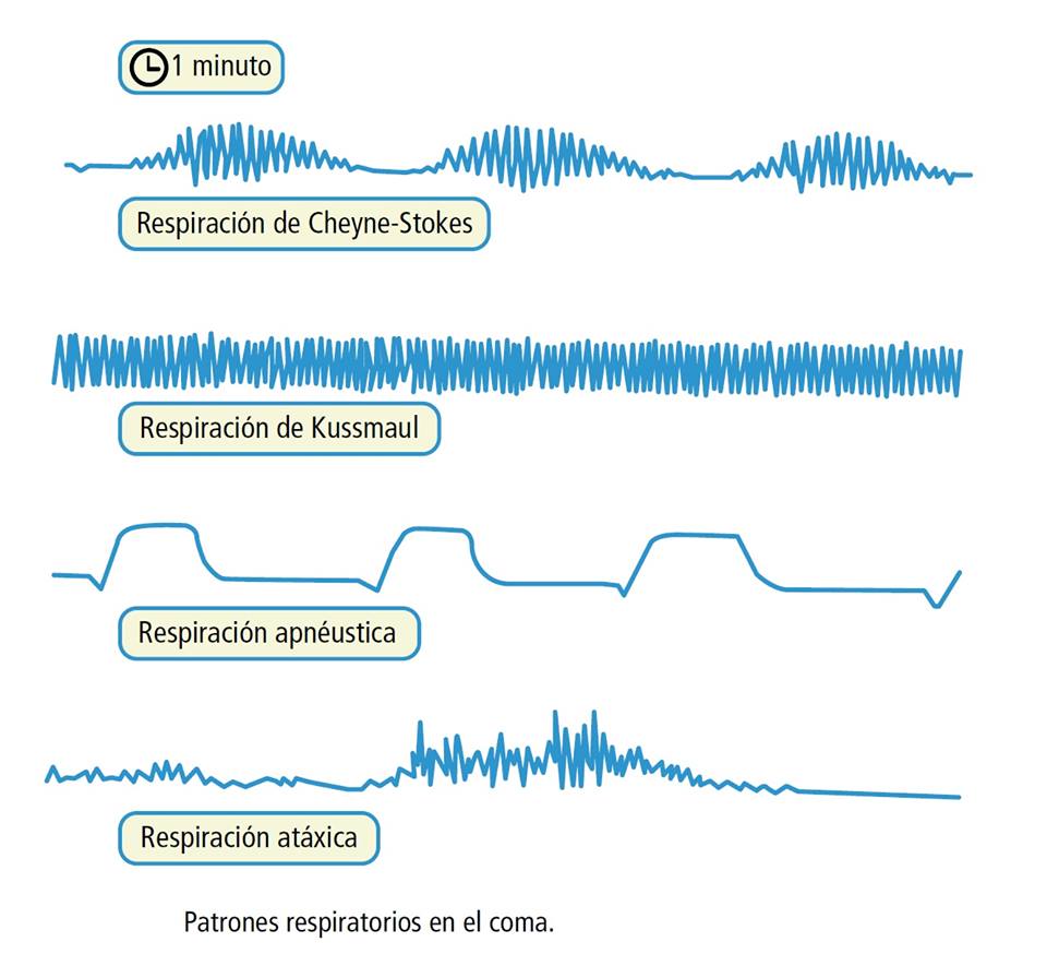 Patrón De Respiración De Kussmaul