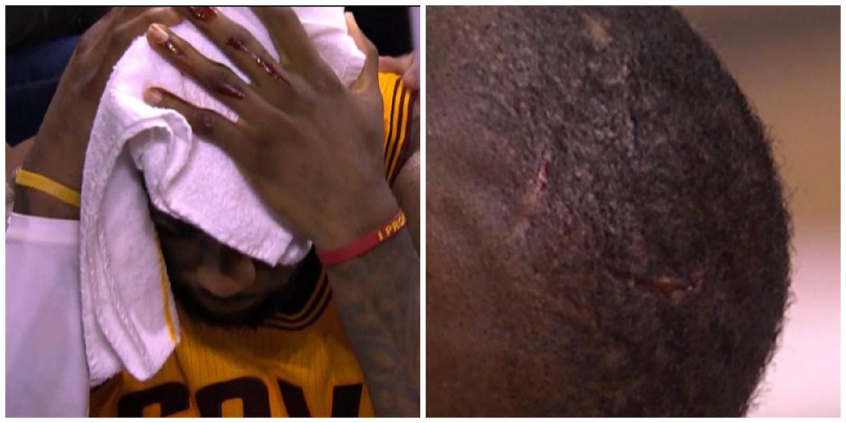 LeBron was bleeding after cutting his head on a courtside camera ...