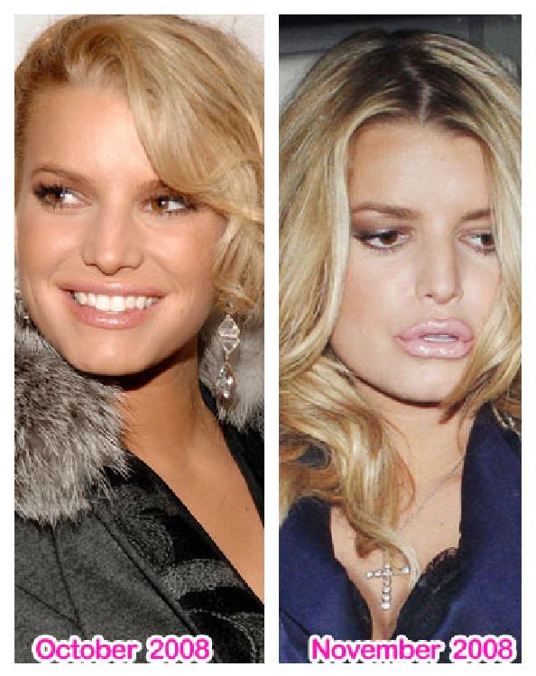 Jessica Simpson Nose Job Before And After