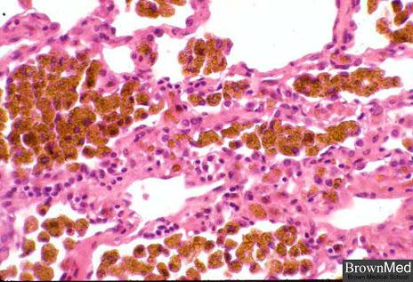 Heart Failure Cells