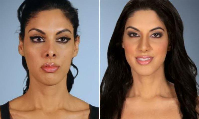 This woman begged doctors to fix a botched rhinoplasty that earned her ...