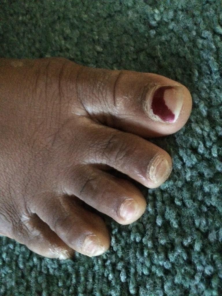 Ratchet Toe Nails