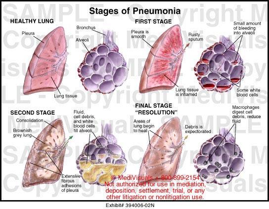 Lobar Pneumonia Stages