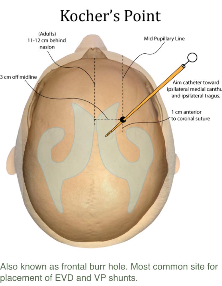 Abdulaziz Almubarak On X: Different EVD Entry Koher's, 56% OFF