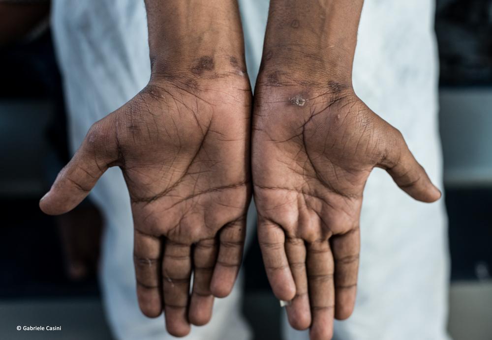 Cigarette Burn Torture