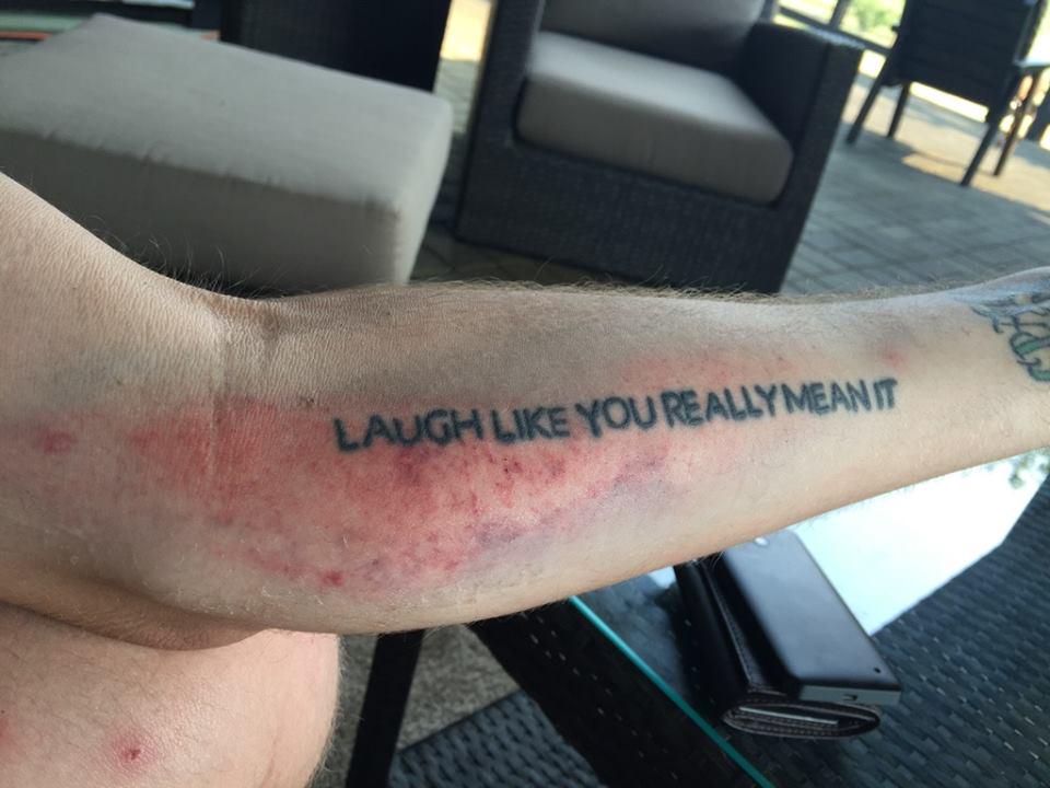 Bow And Arrow Injuries