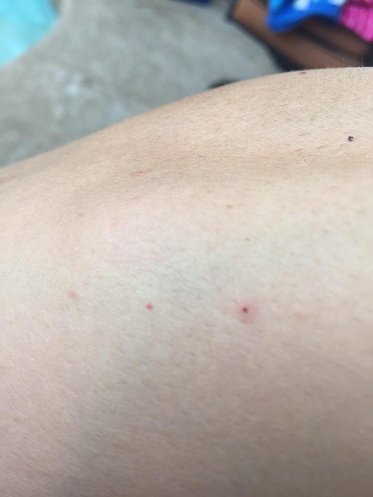 Needle Shot Mark