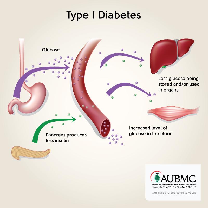 Type 1 Diabetes Diagram
