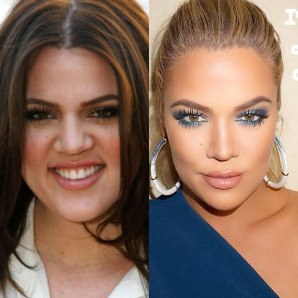 Khloe Kardashian Before And After Nose Job