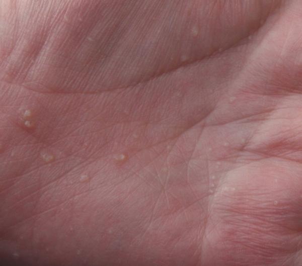 Punctate Keratosis