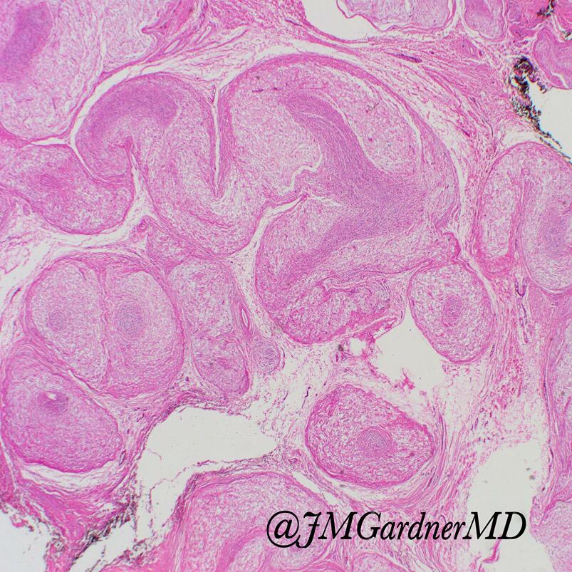 Plexiform Neurofibroma Histopathology