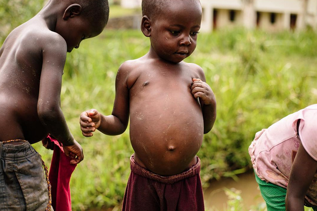 Starving African Child Belly