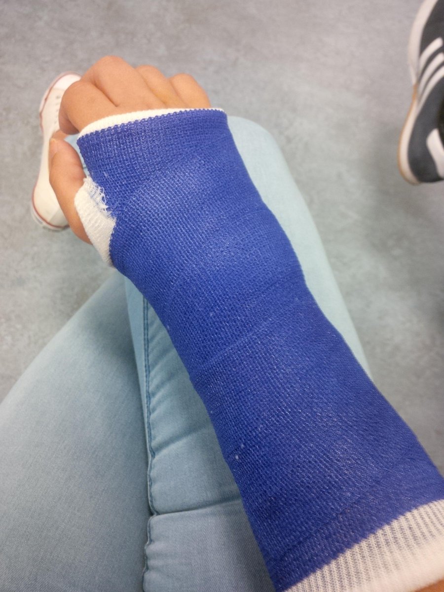 Broken Hand Cast