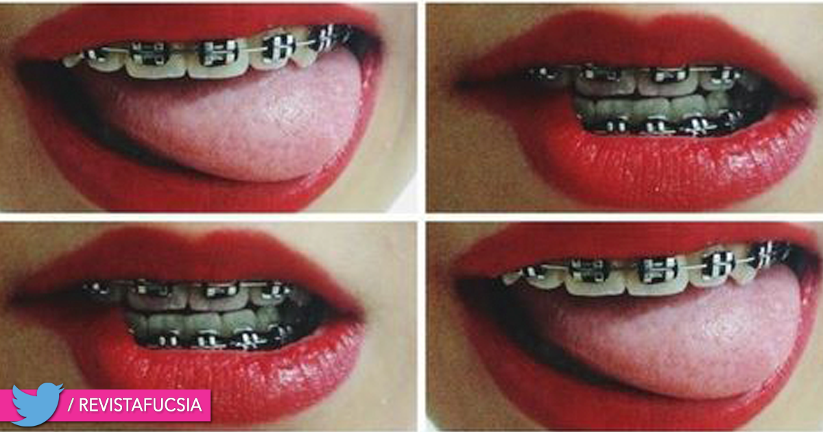 #blogsfucsia | lleva brackets con estilo. por tatiana navarrete ...