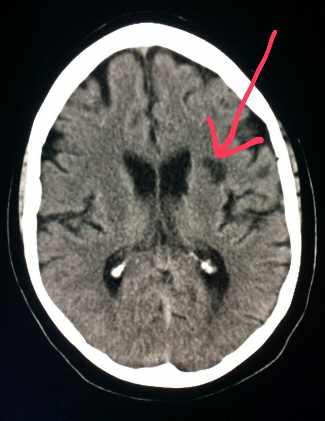 Lacunar Infarct