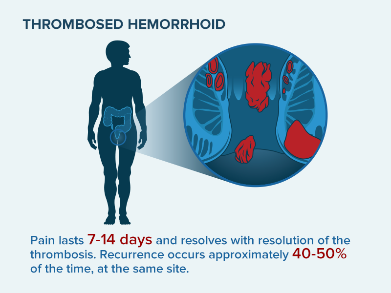 Thrombosed Hemorrhoid