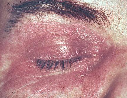 Heliotrope Rash Eyelid