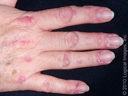 Gottrons Papules