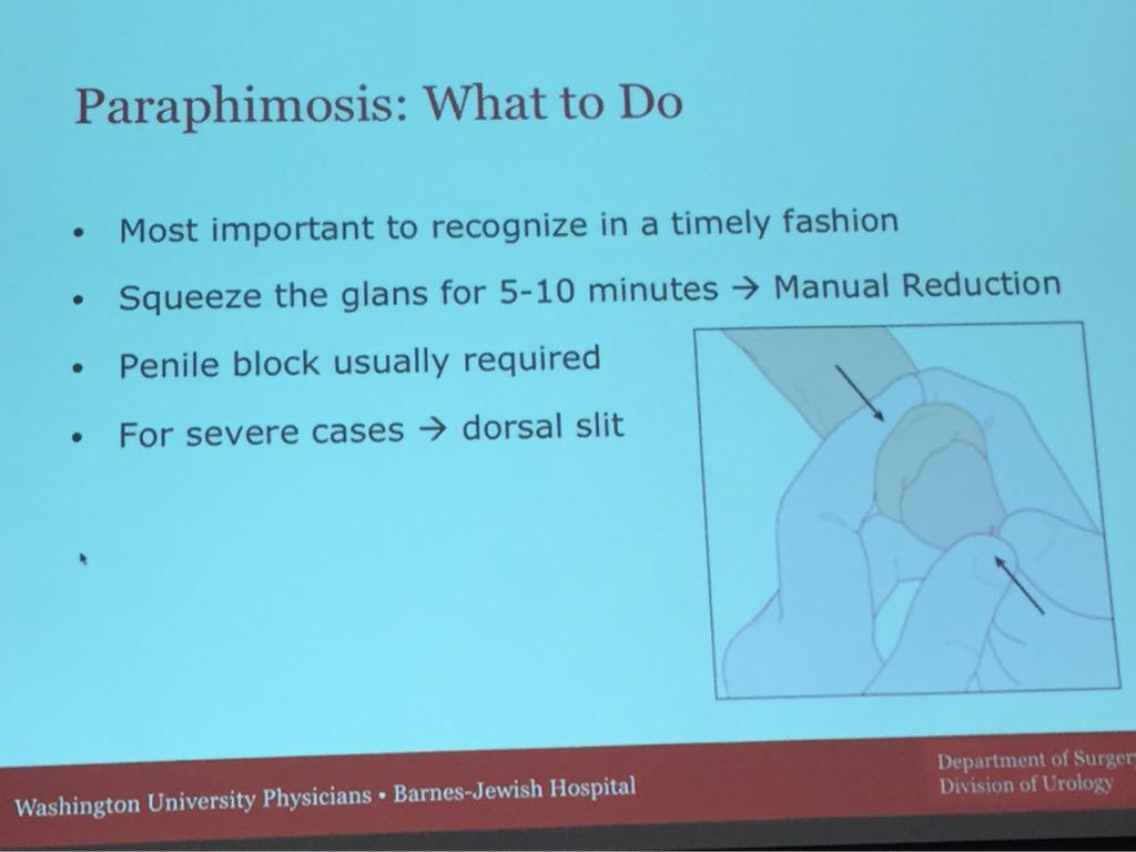 Paraphimosis Dorsal Slit