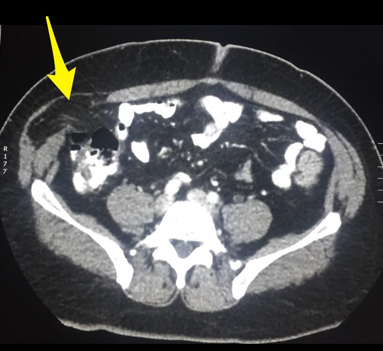 Spigelian Hernia Radiology