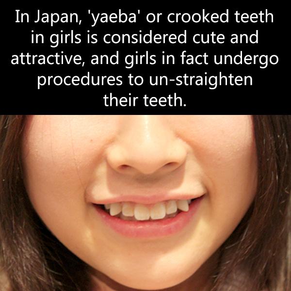 Yaeba Teeth Before And After Crooked Teeth | Causes And Treatments