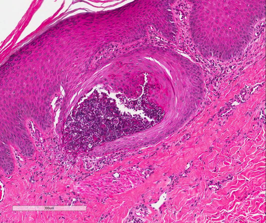 Elastosis Perforans Serpiginosa