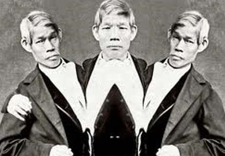 Conjoined Triplets Photos