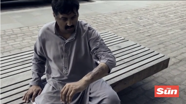 Man’s 8-inch bionic penis, made with skin from his arm, replaces the ...