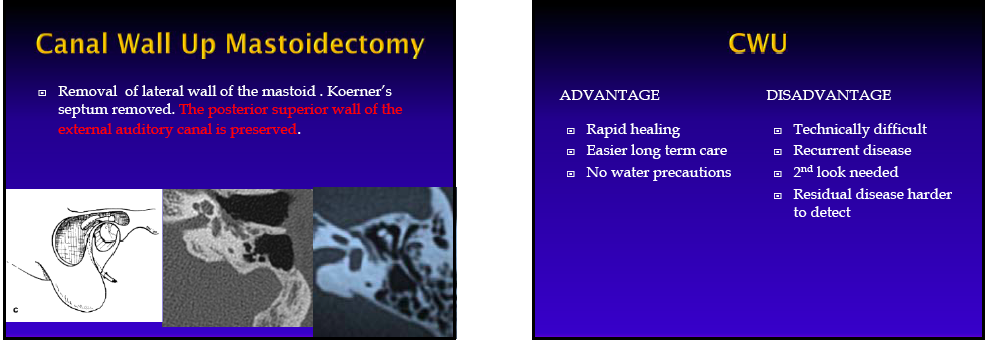 Canal Wall Down Mastoidectomy Radiology