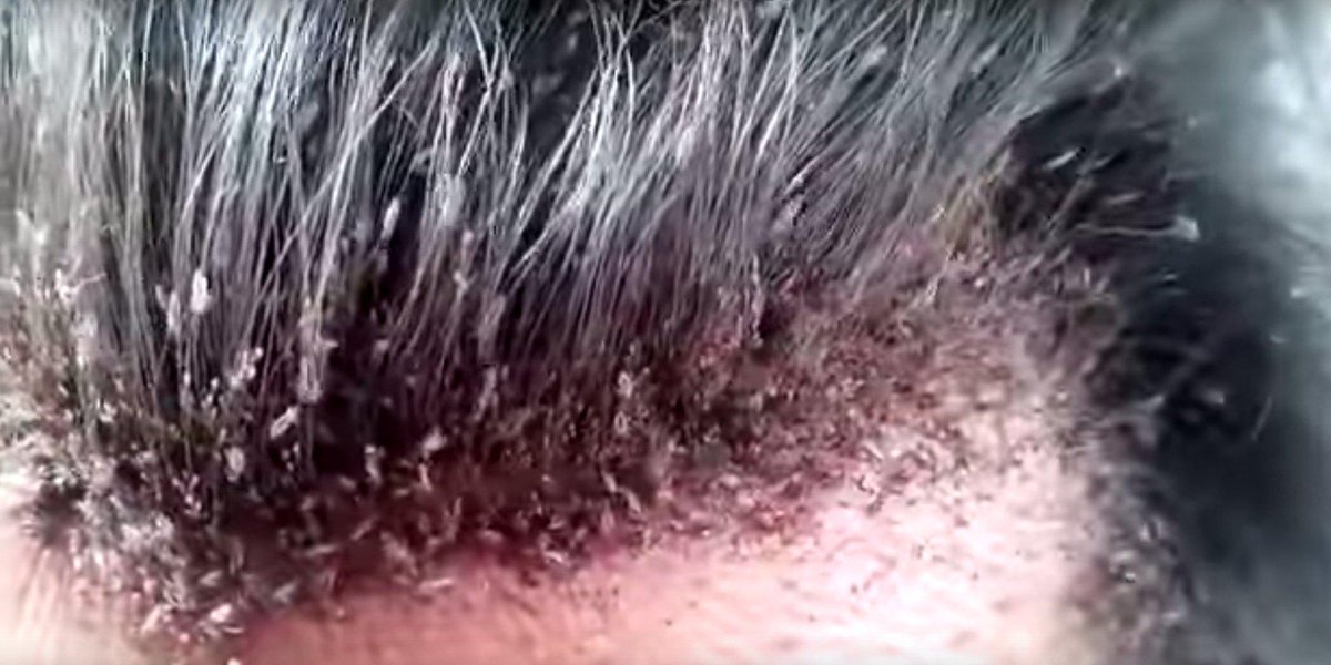 VIDÉO RÉPUGNANTE - Cet homme a les cheveux remplis de poux | HuffPost ...