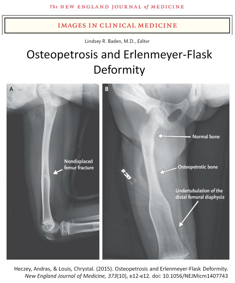 Erlenmeyer Flask Deformity