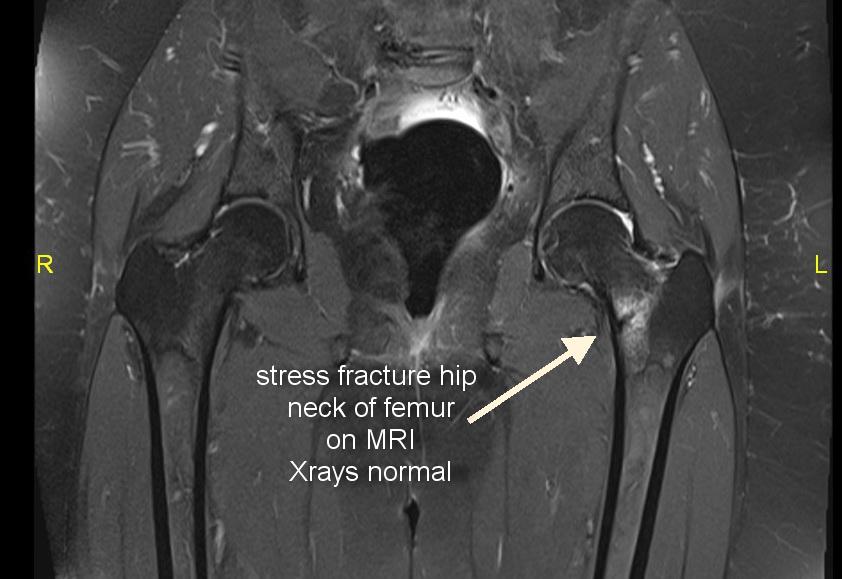 Stress Fracture Mri