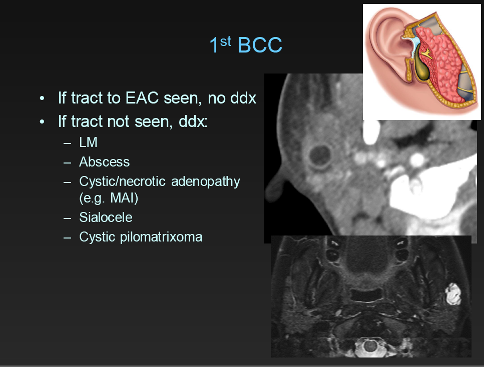 First Branchial Cleft Cyst