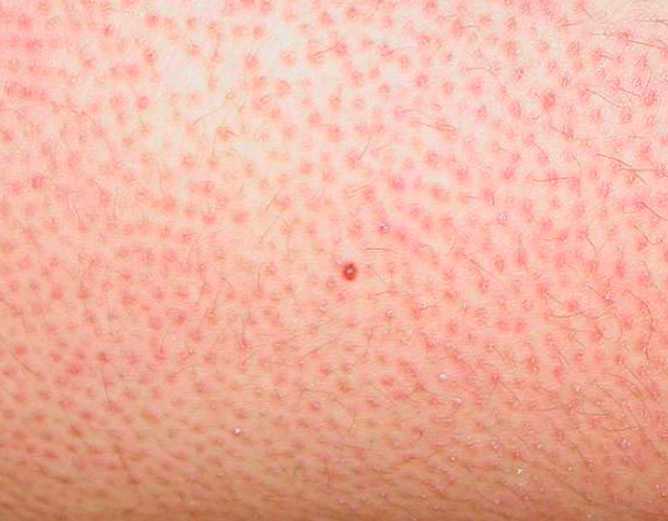 Ce que vous devez savoir sur ces points rouges gênants sur vos bras ...